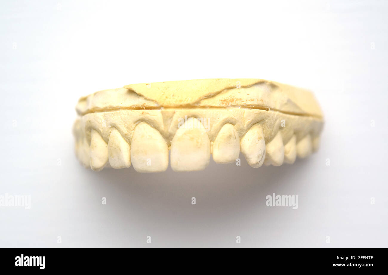 Plaster impression of teeth with small gap in front teeth (diastema ...