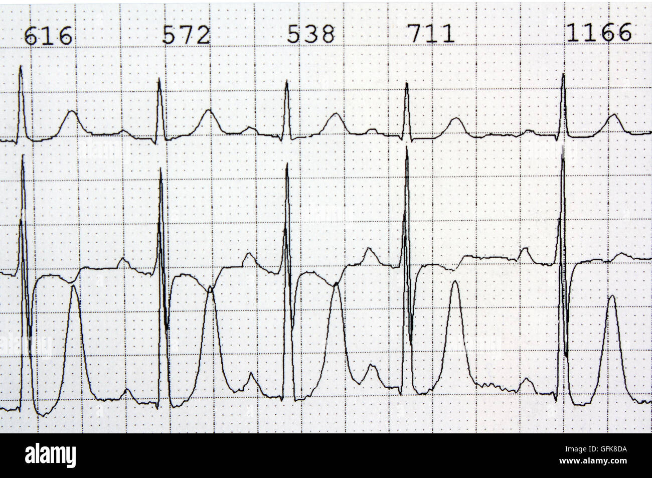 Electrocardiogram ekg heart rhythm disease cardiology background Stock ...