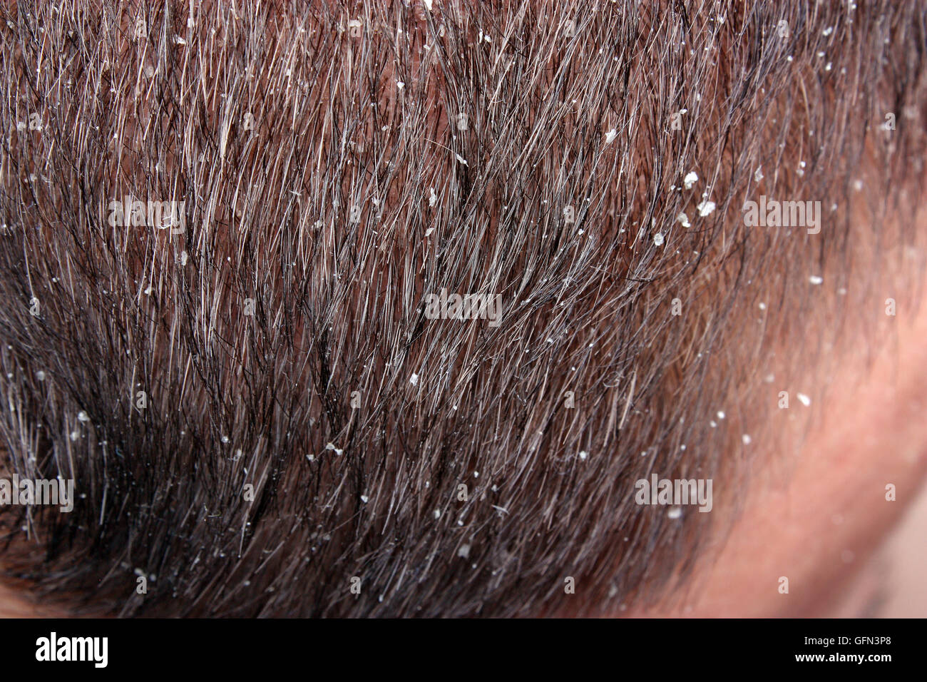 Dandruff in the hair of a man Stock Photo - Alamy