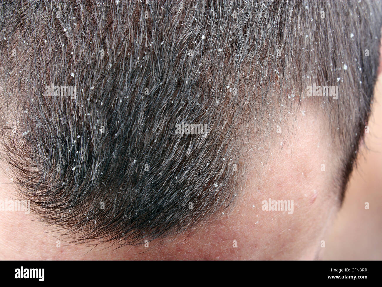 Hair loss symptoms hi-res stock photography and images - Alamy