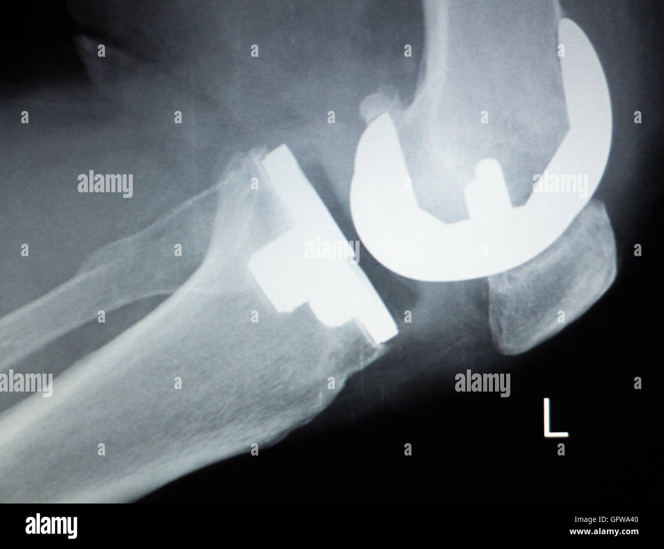 Knee joint replacement orthopedic titanium metal Traaumatology ball and ...