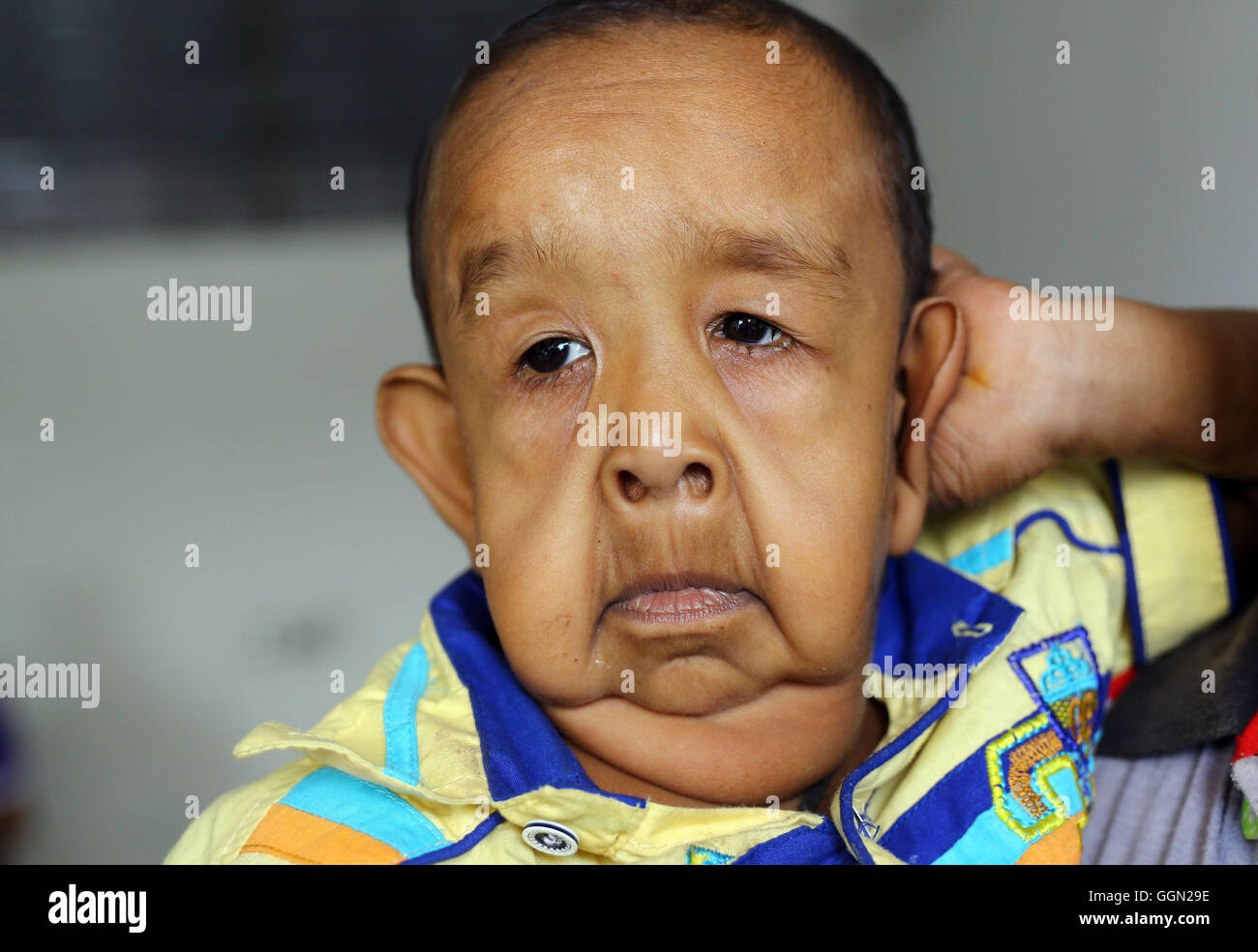 Group Of Kids With Progeria