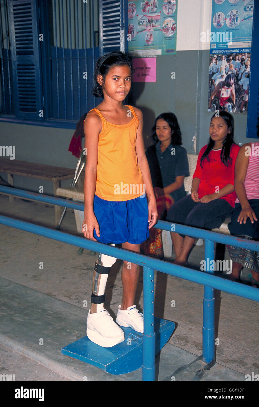 Young Girl Learning To Balance Using A Prosthetic Limb Siem Reap