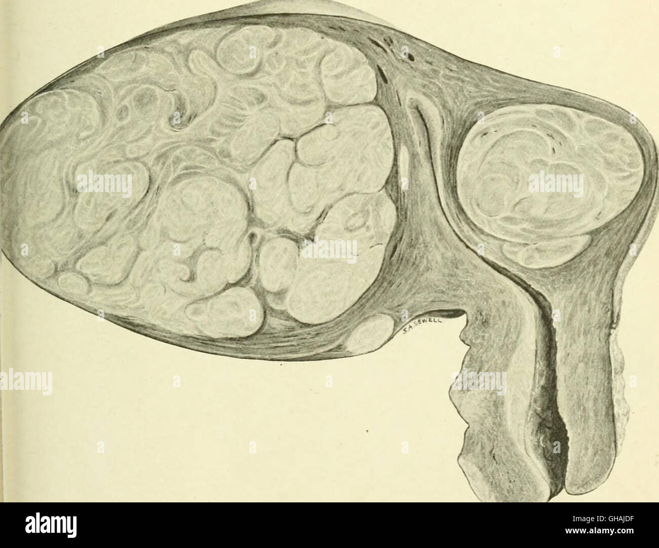 This 1918 medical text focuses on the pathology, clinical ...