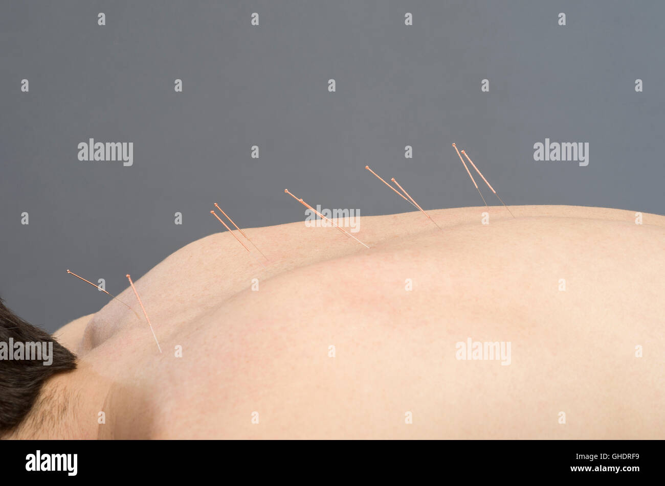 Chinese medicine doing acupuncture to man patient Stock Photo - Alamy
