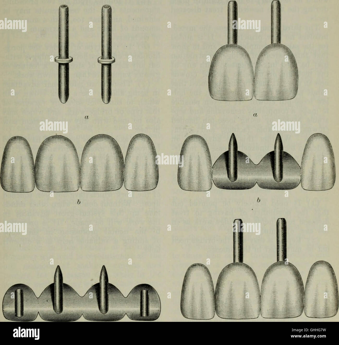 Removable bridge;The Dental Stock Photo - Alamy