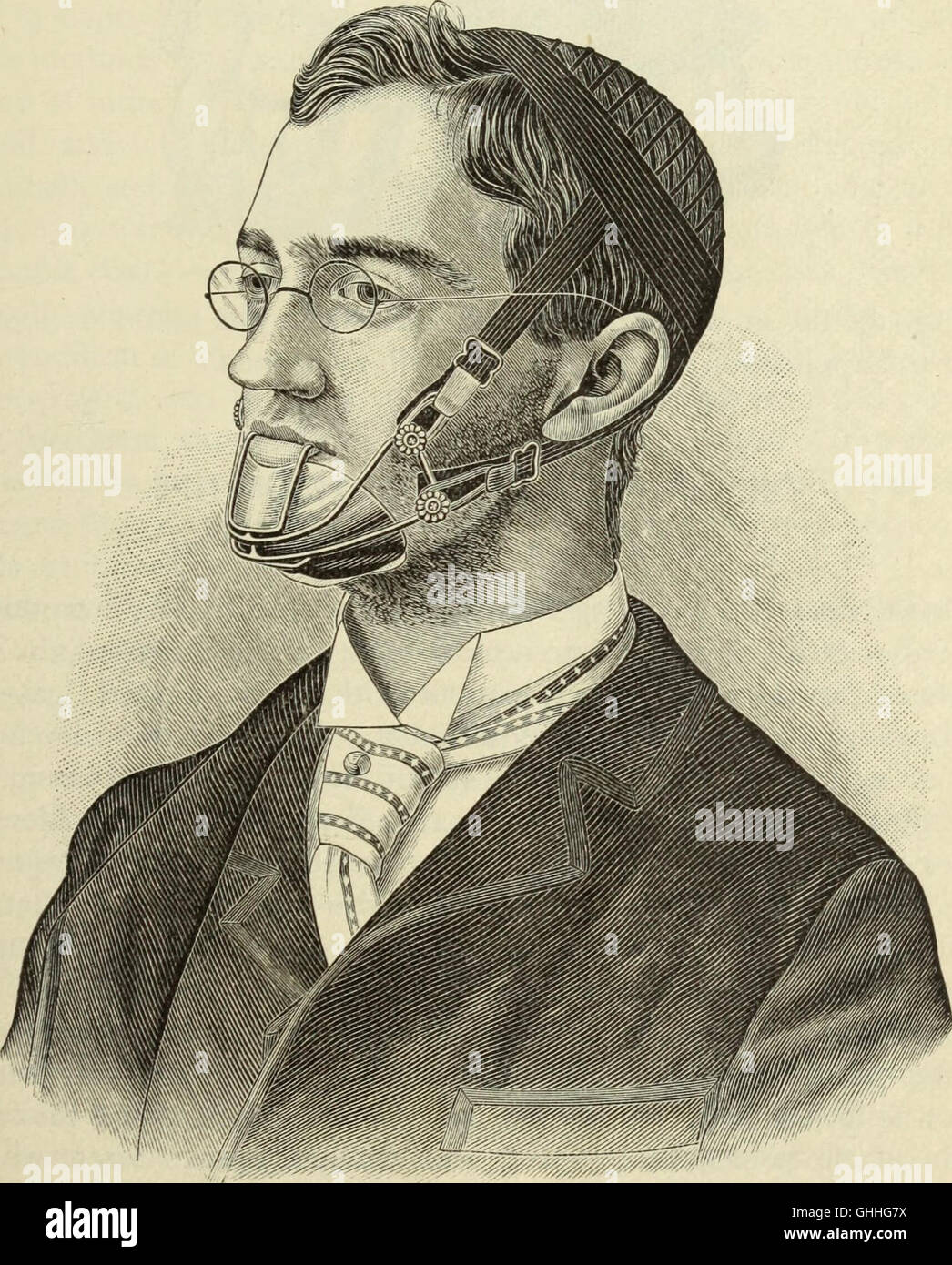 This work discusses various types of dental headgear used in ...