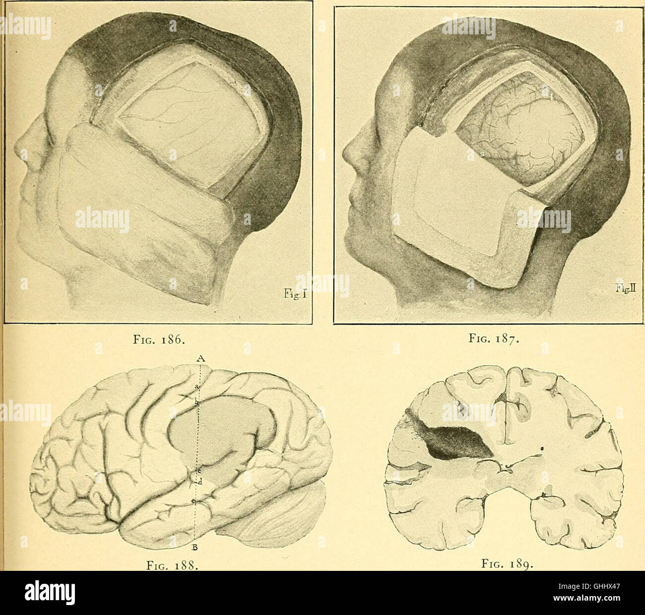 Some points in the surgery of the brain and its membranes (1907 Stock ...