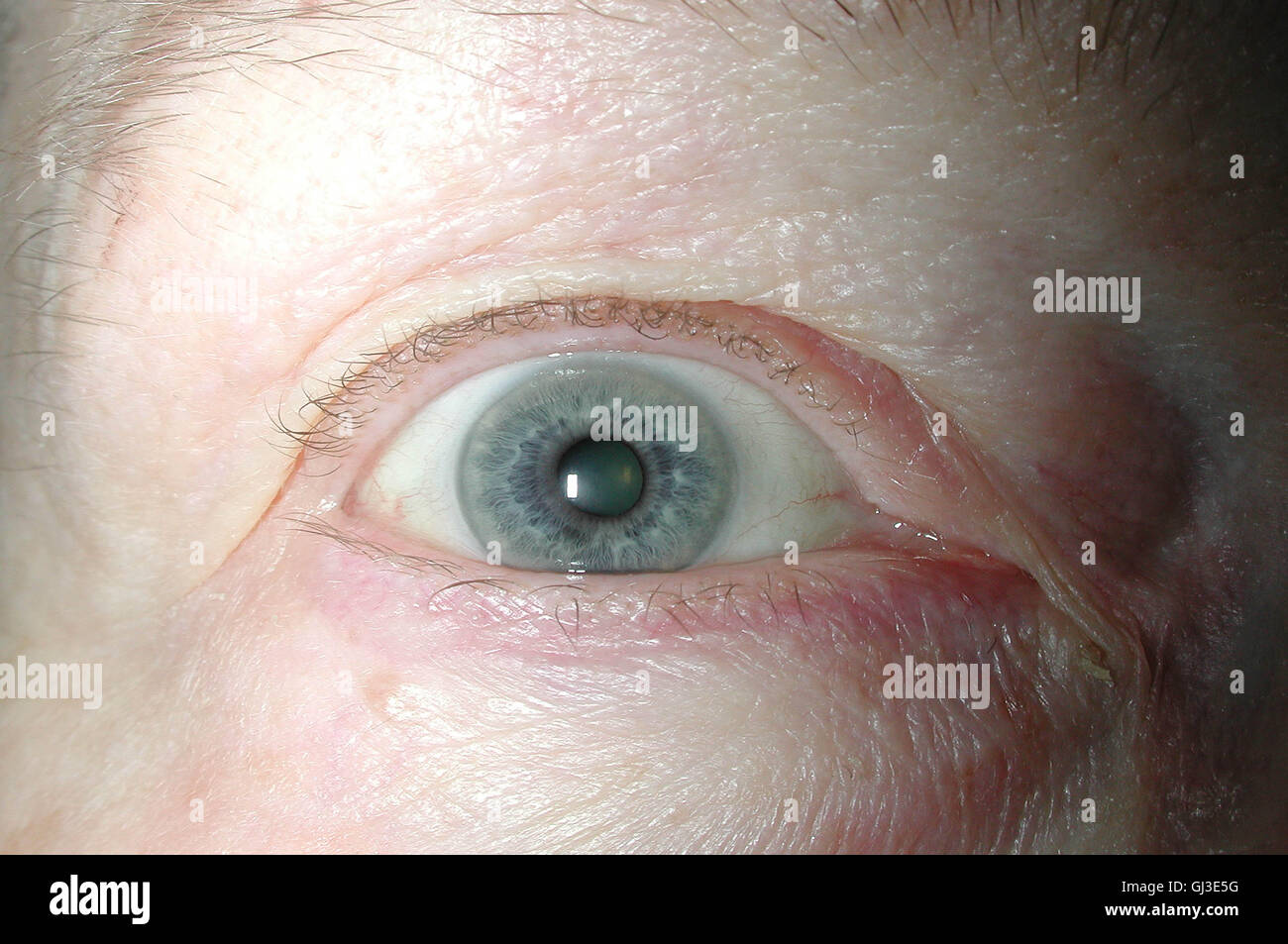 Eye with cataract, A cataract is a clouding of the lens inside the eye ...