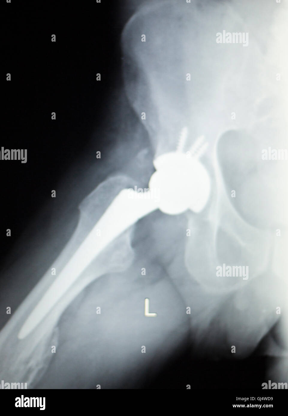 Joint replacement orthopedic titanium hi-res stock photography and ...