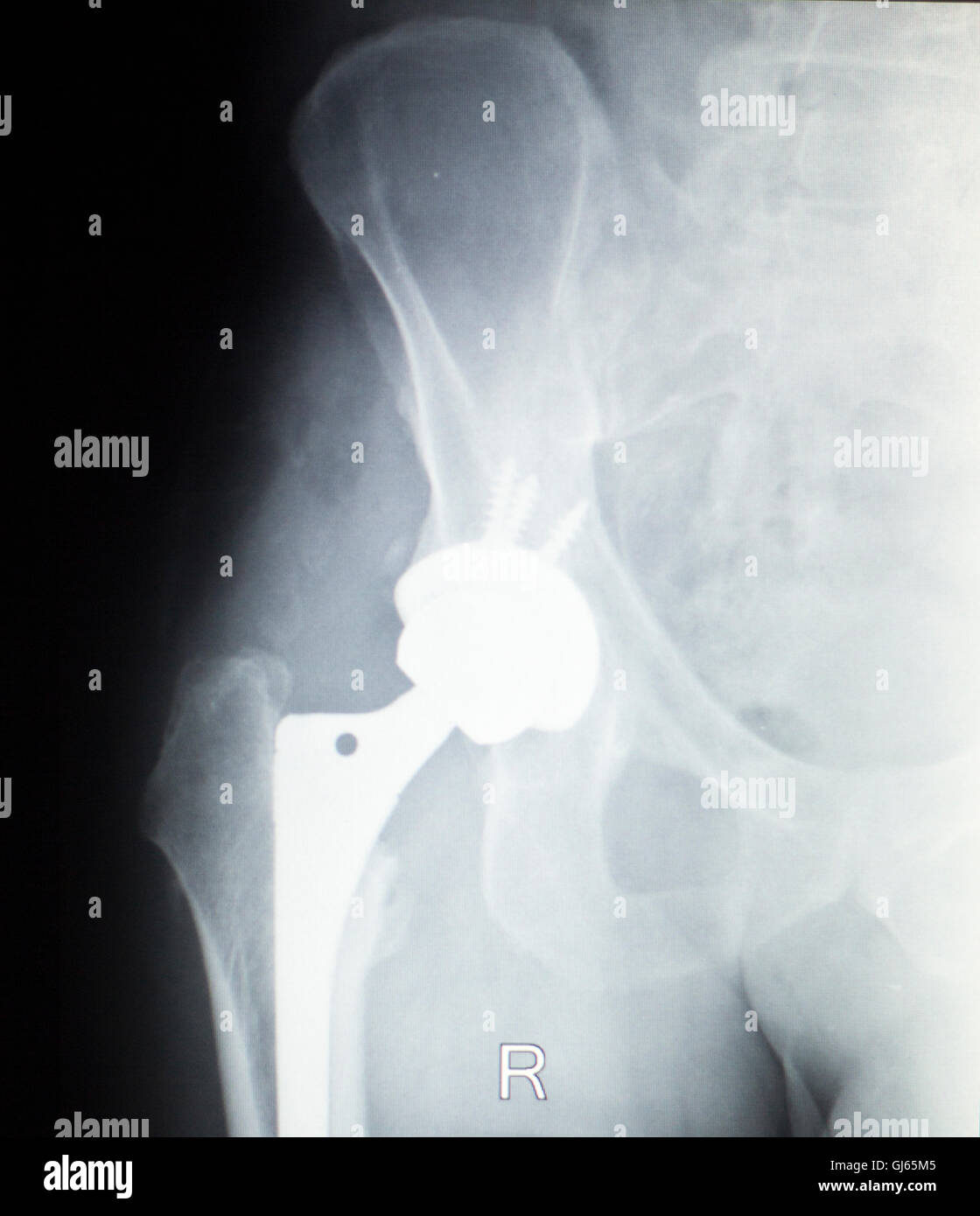 Hip joint replacement orthopedic titanium metal Traaumatology ball and ...