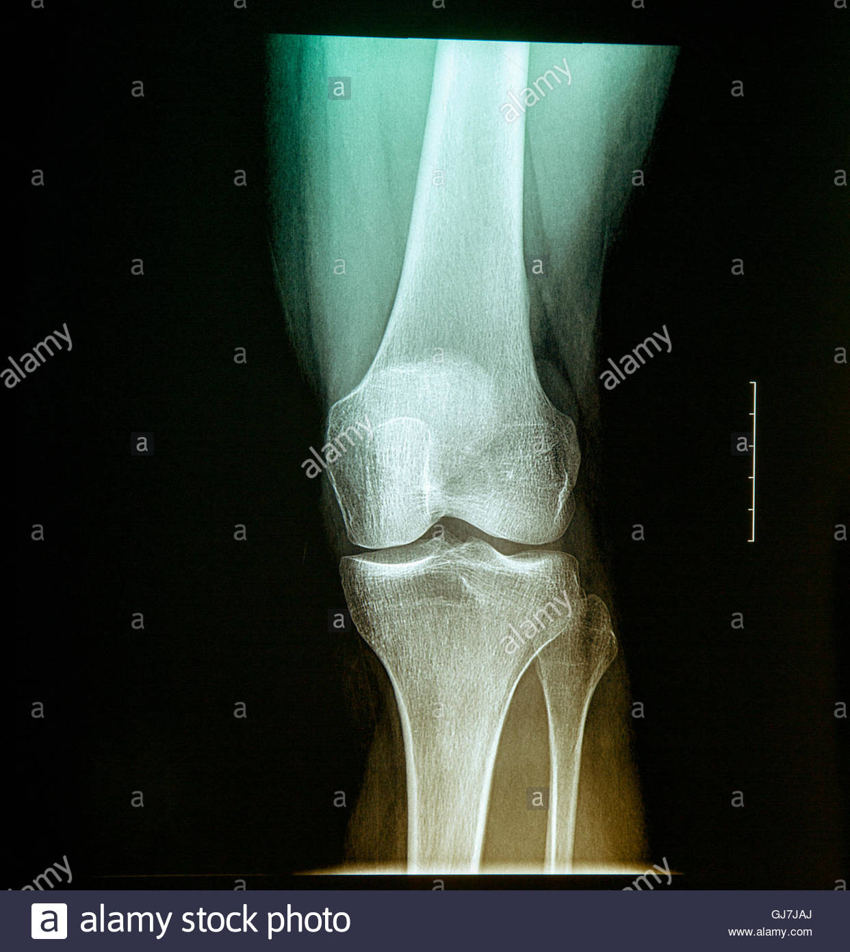 X Ray Image Knee Stock Photos & X Ray Image Knee Stock Images - Alamy