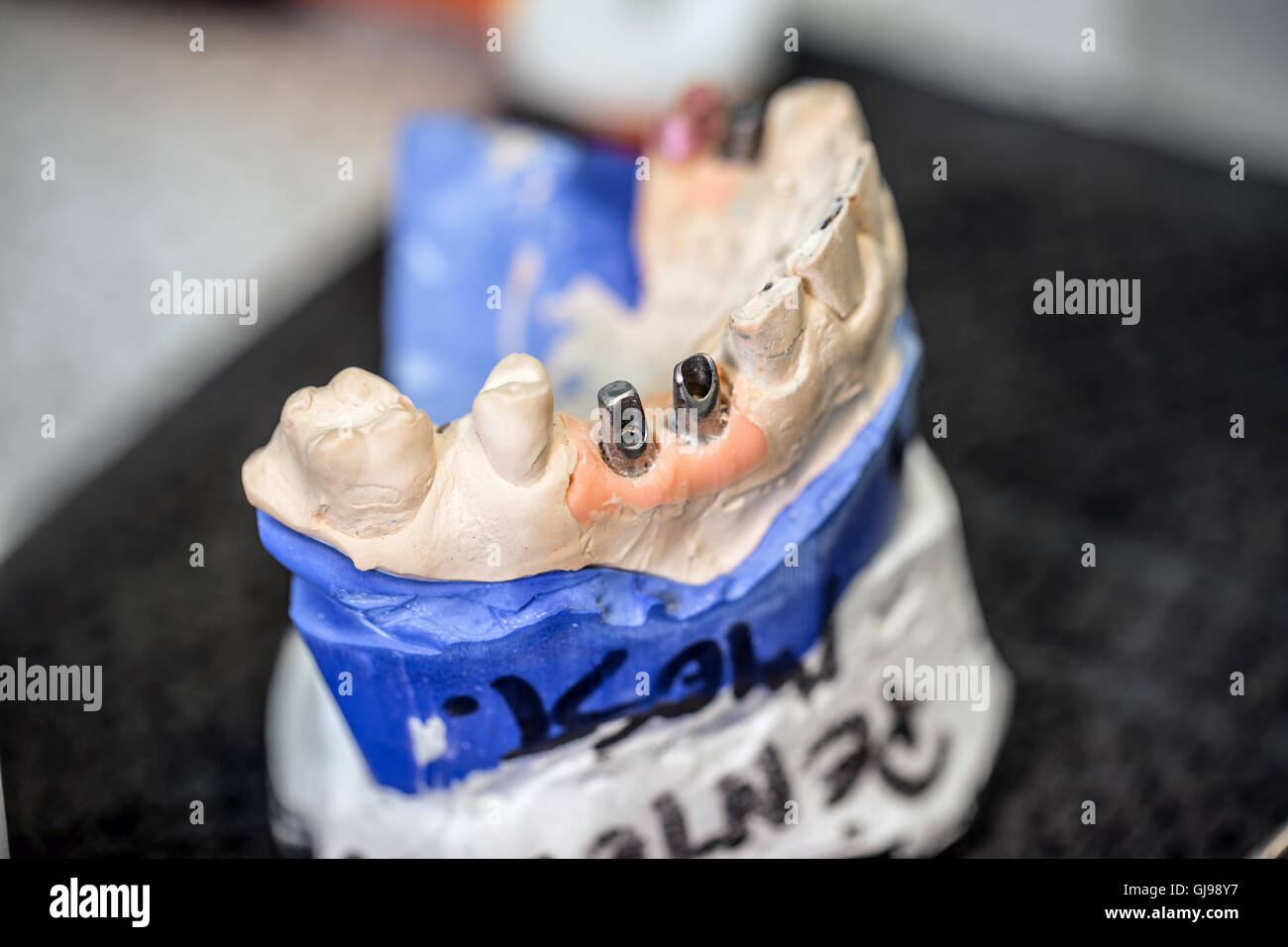 Dental implants in dental model Stock Photo - Alamy