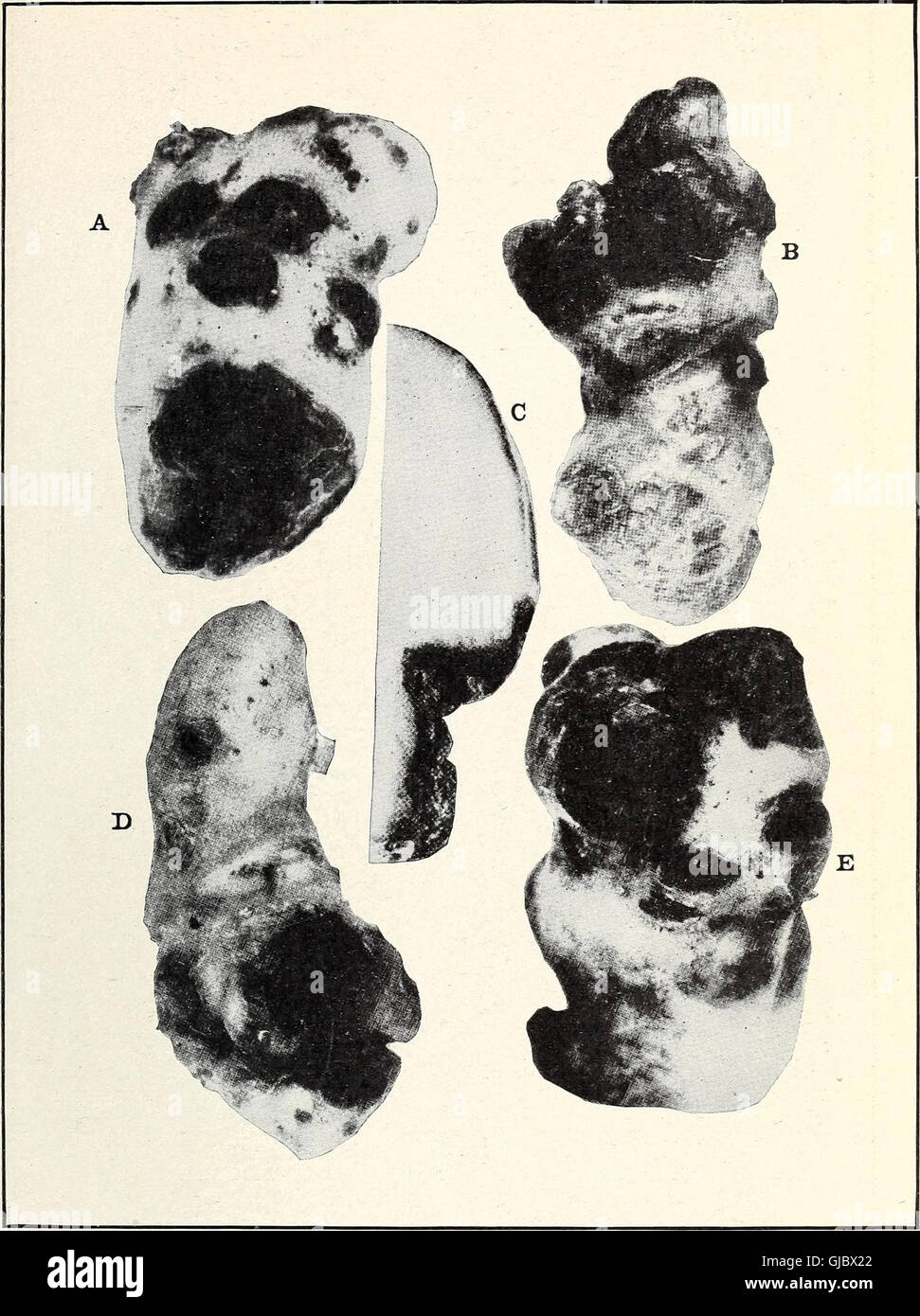 Powdery scab (Spongospora subterranea) of potatoes (1914 Stock Photo ...