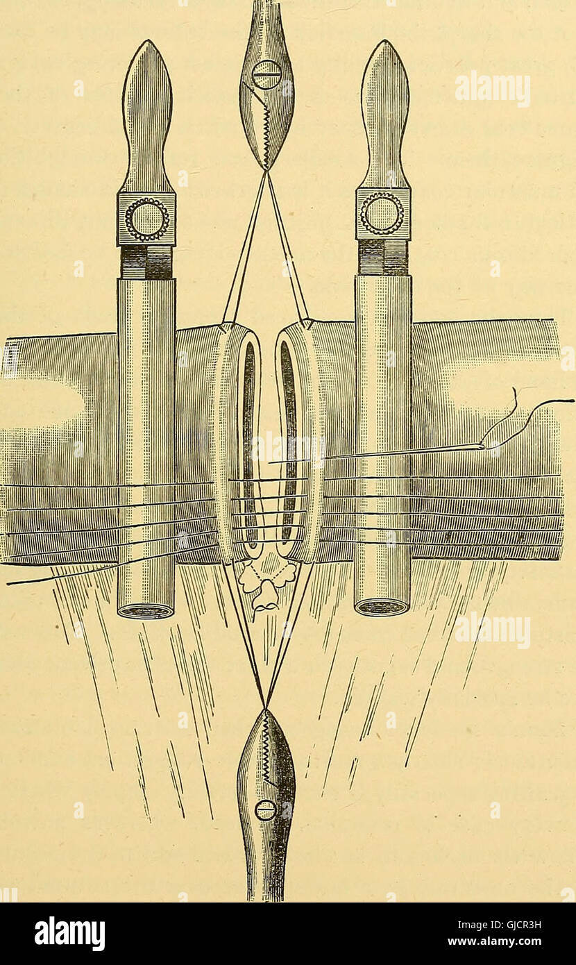 An 1889 medical text focused on abdominal surgery, detailing procedures ...