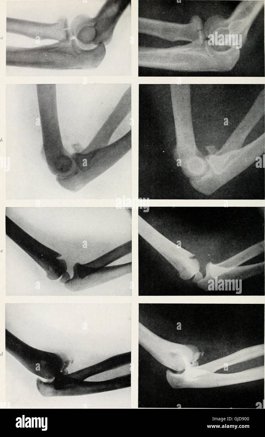 Radiography, X-ray therapeutics and radium therapy (1916 Stock Photo ...