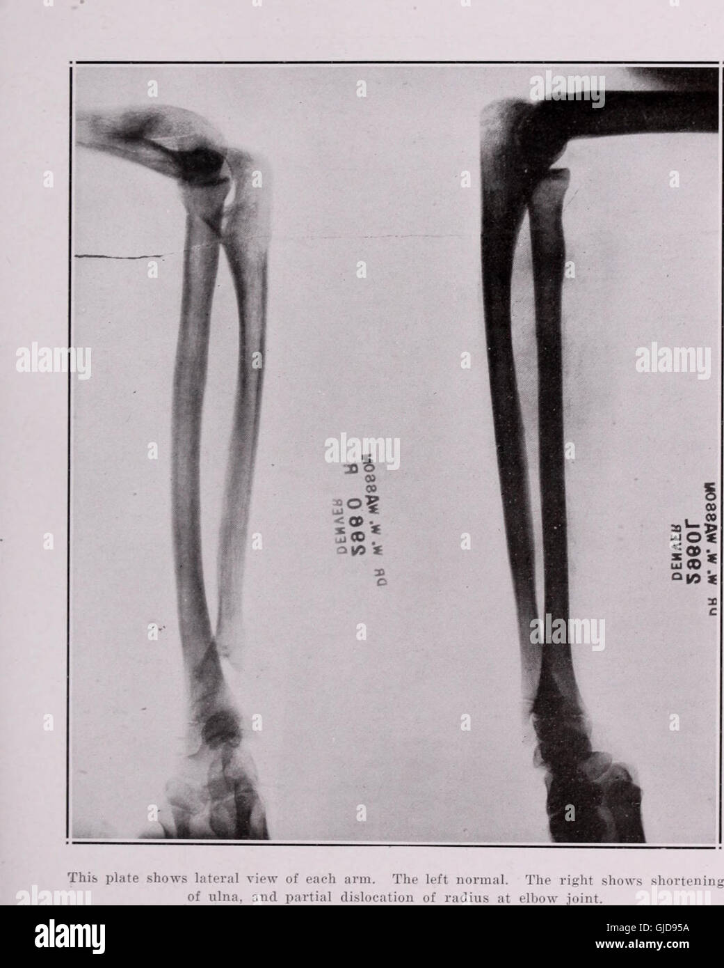 The 1921 Journal of Radiology includes articles on early radiological ...