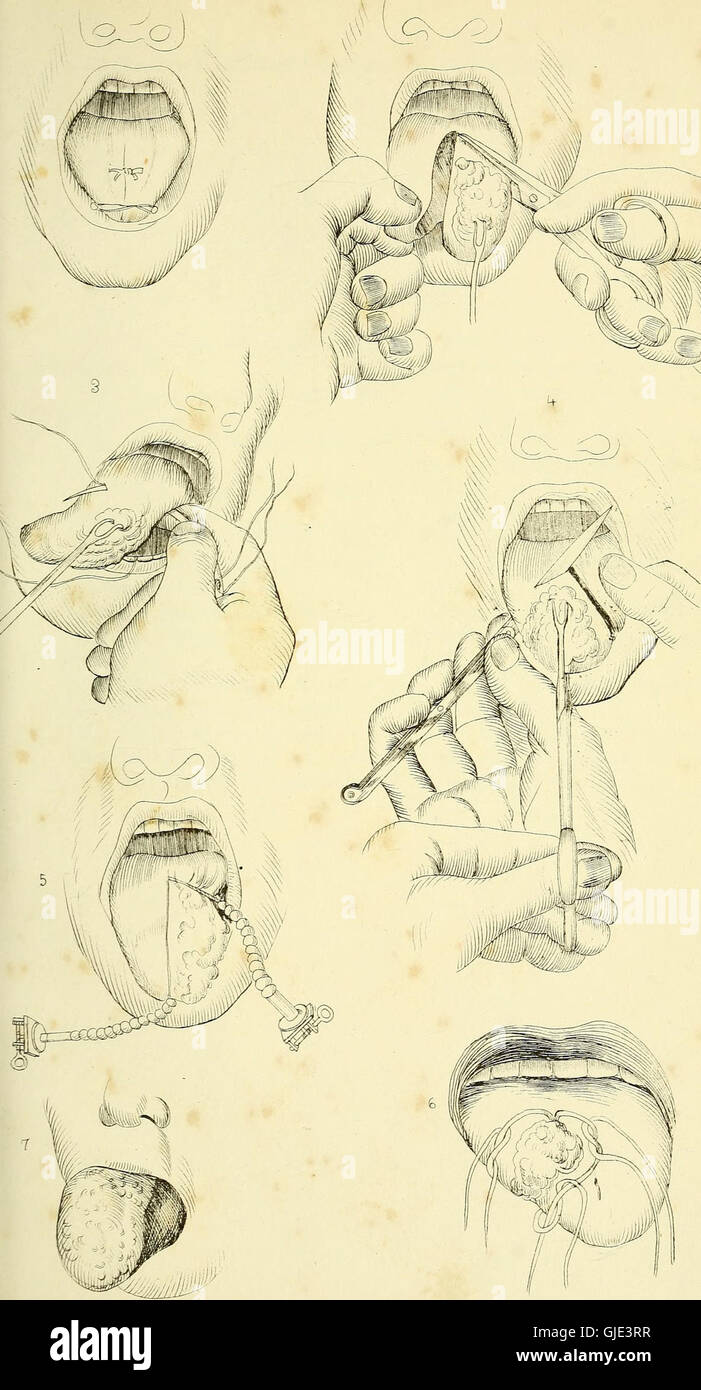 This illustrated surgical manual from 1852 provides detailed engravings ...