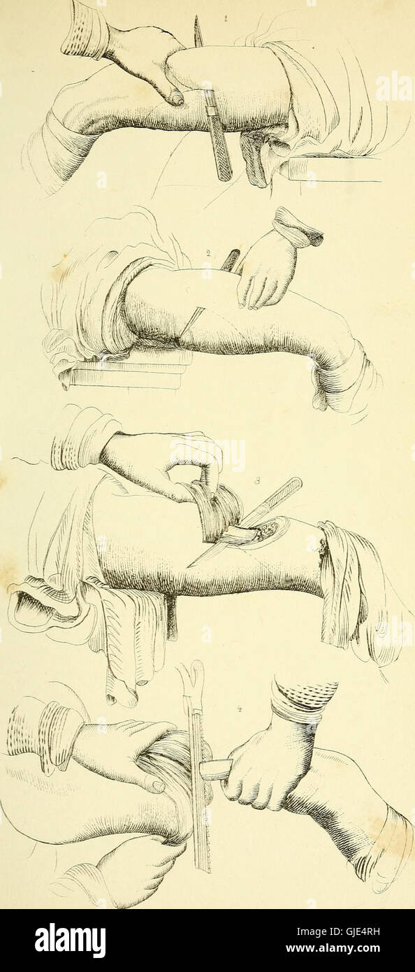 An extensive surgical reference work from 1852, featuring over 1,900 ...