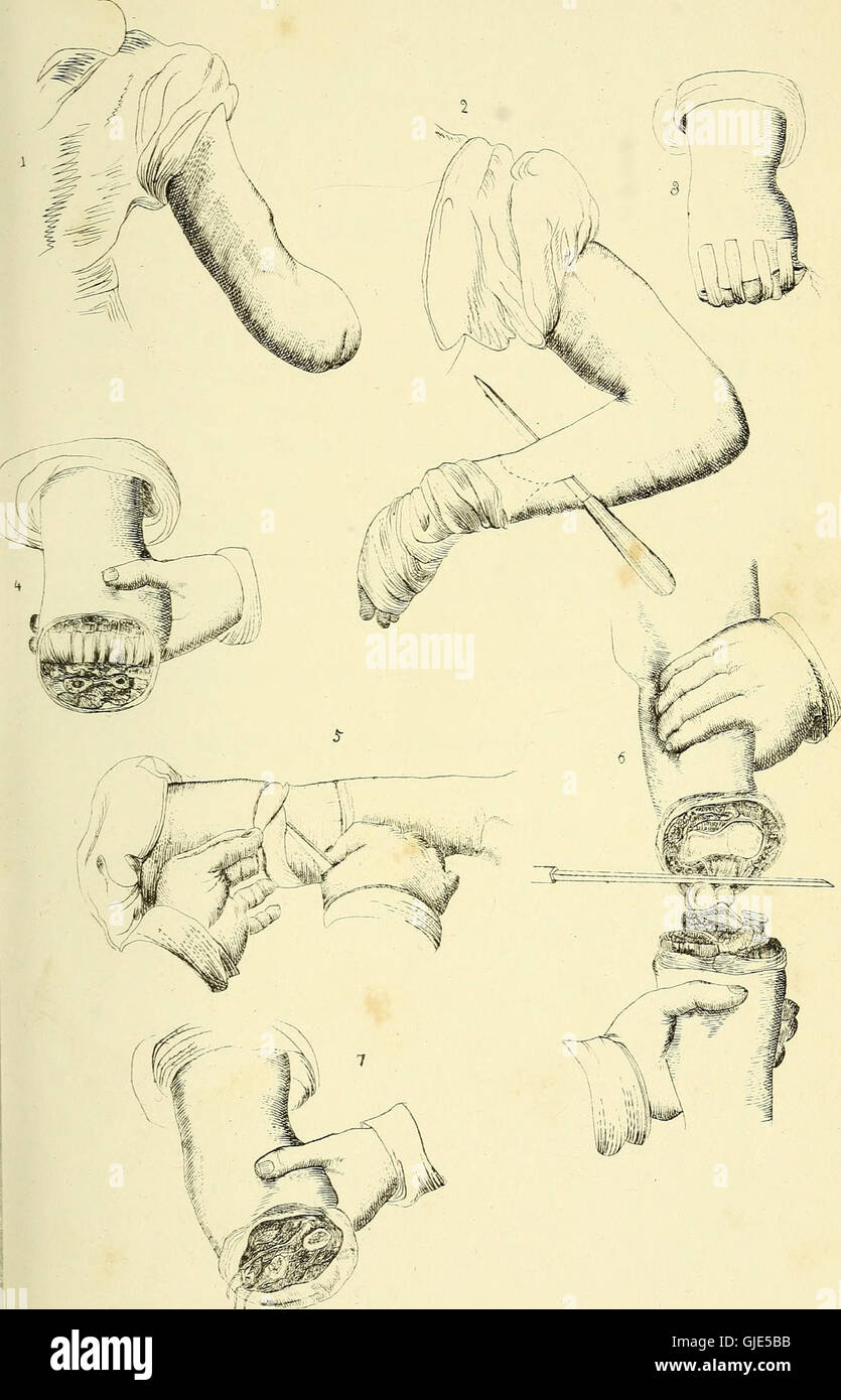 A surgical reference work from 1852, illustrated with over 1,900 ...
