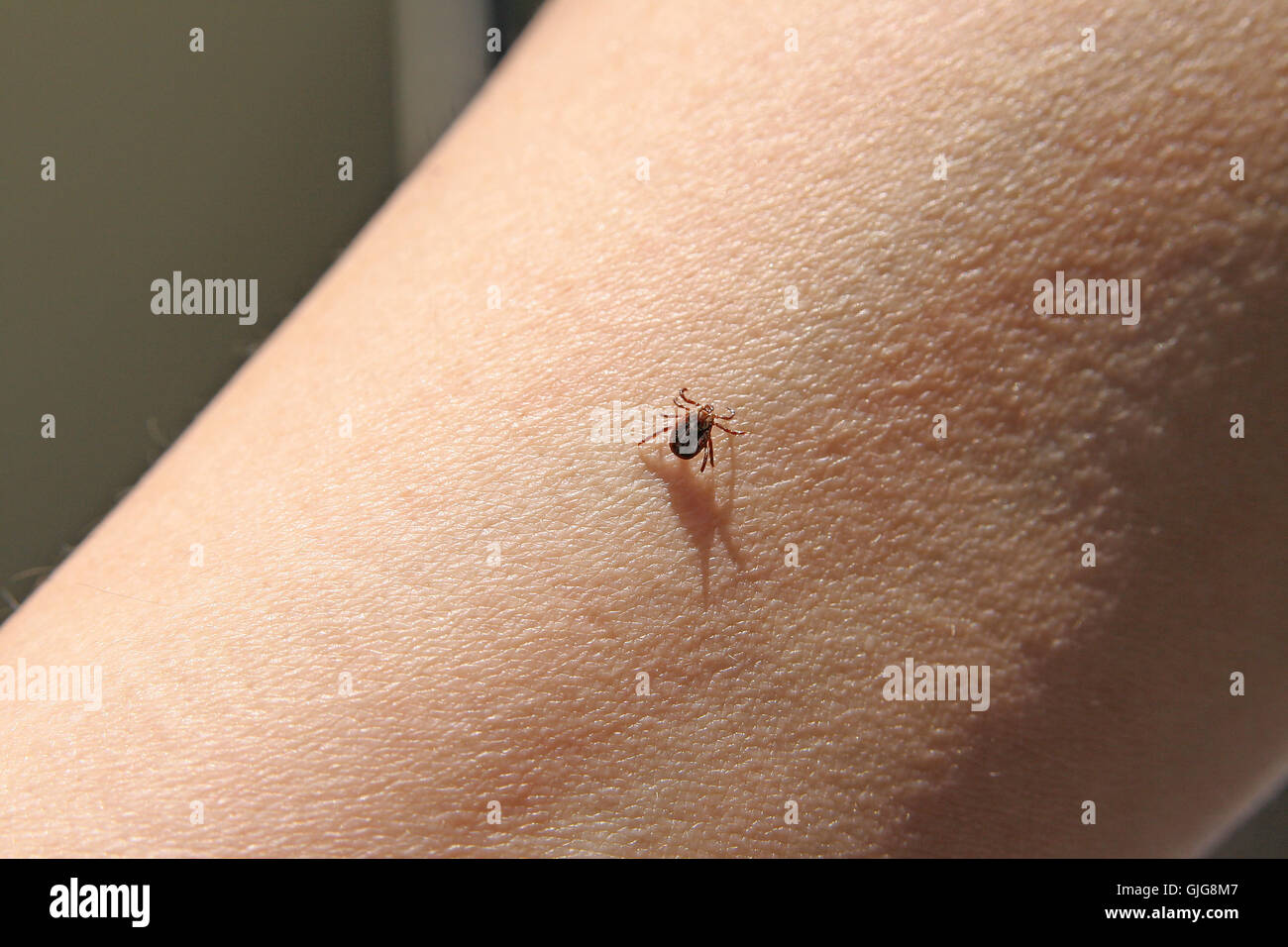 Tick bite hi-res stock photography and images - Alamy