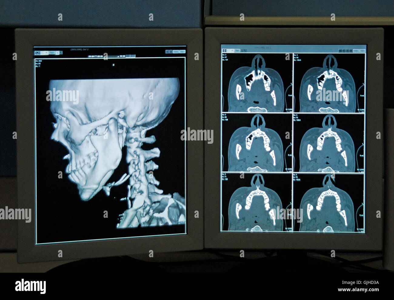 X ray photograph hi-res stock photography and images - Alamy