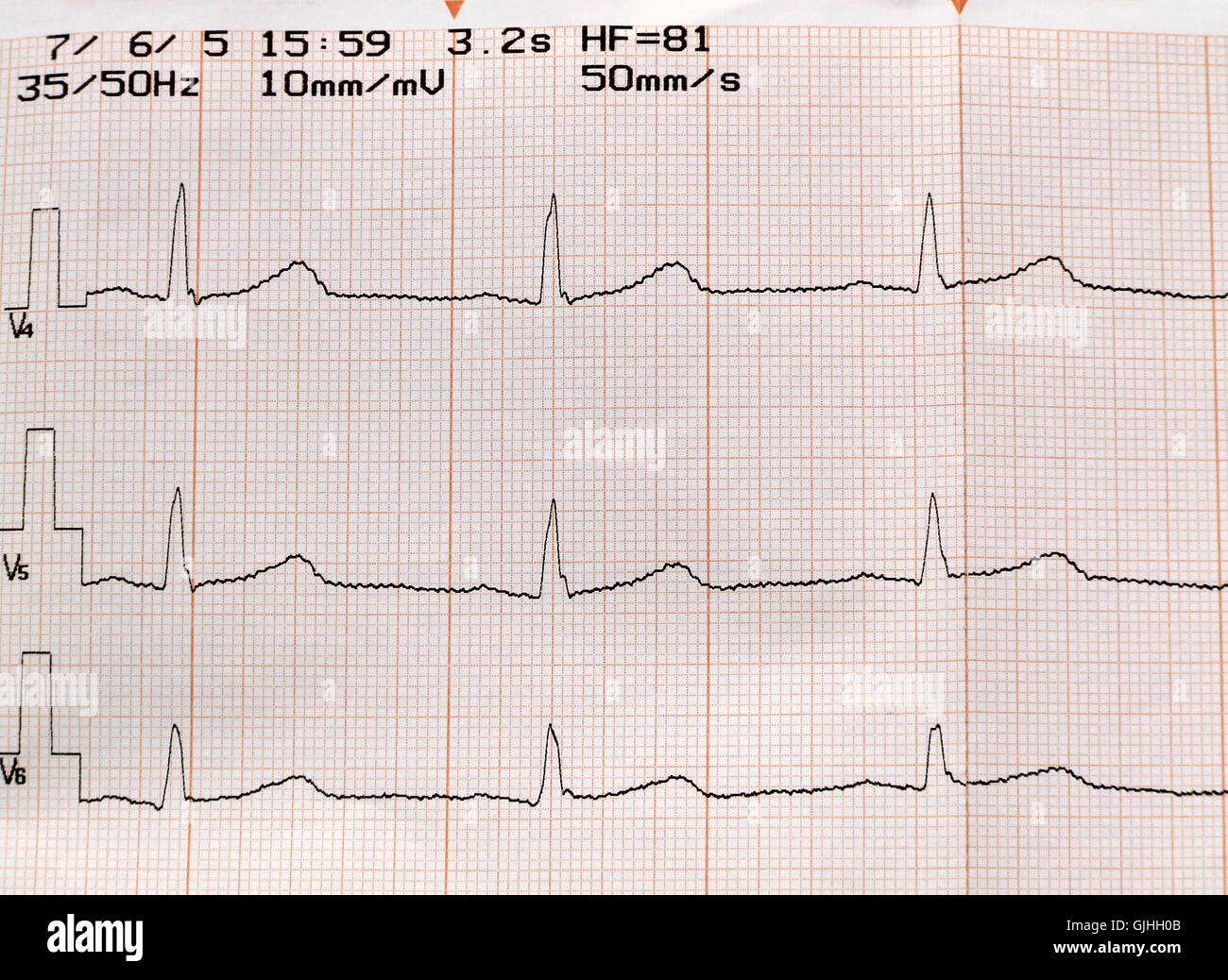 Ecg recording hi-res stock photography and images - Alamy