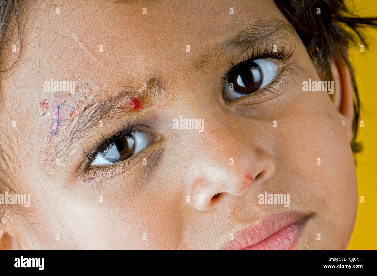 Laceration wound hi-res stock photography and images - Alamy