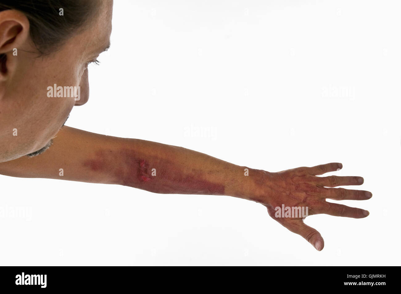Burn Scar Hand Stock Photos & Burn Scar Hand Stock Images - Alamy
