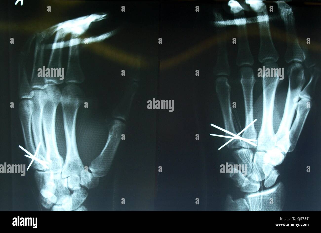 hand radiograph diagnosis Stock Photo - Alamy