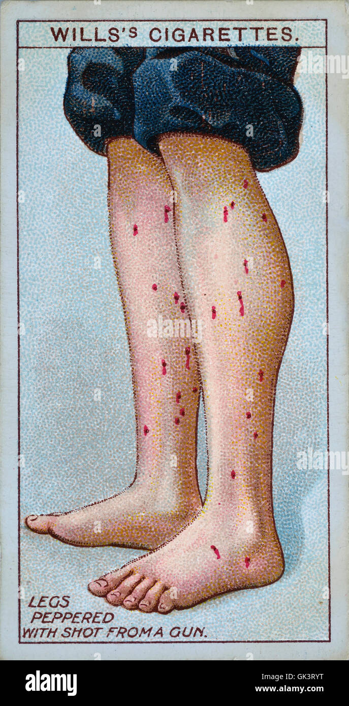 Gun wound hi-res stock photography and images - Alamy