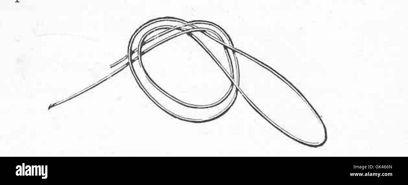 The knotting loop in the gut refers to a complex twist or knot in the ...