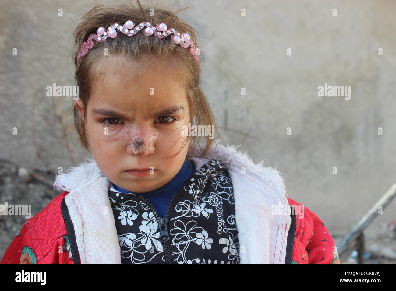 Leishmaniasis face hi-res stock photography and images - Alamy