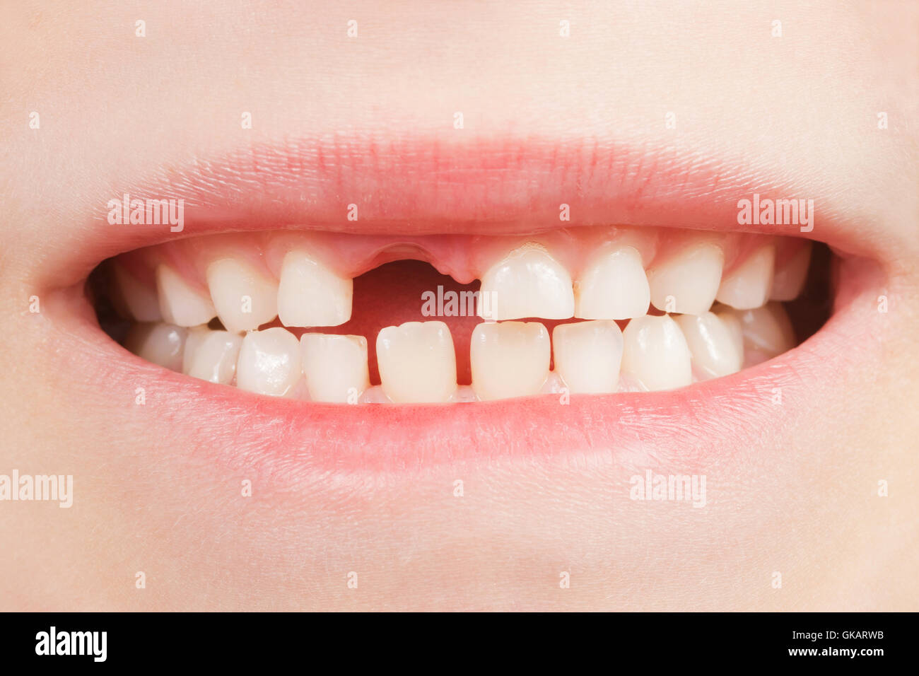 child with tooth gap Stock Photo - Alamy