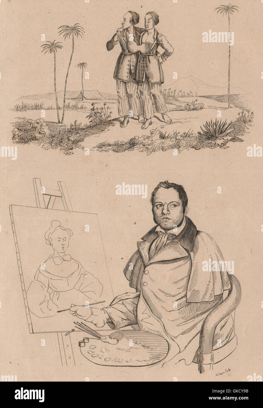 BIOLOGY: Anomalies Humaines (Human Abnormalities). Conjoined twins ...