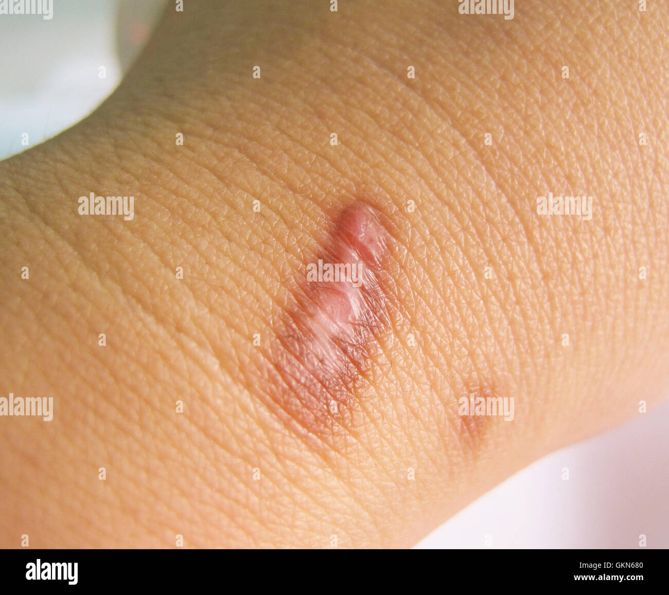 Burn scar hi-res stock photography and images - Alamy