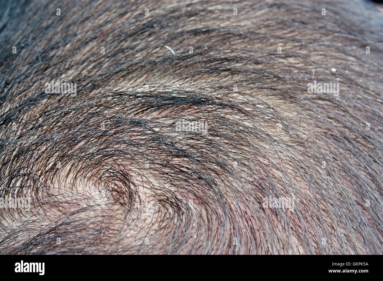 Caucasian young man dandruff in the hair Stock Photo - Alamy