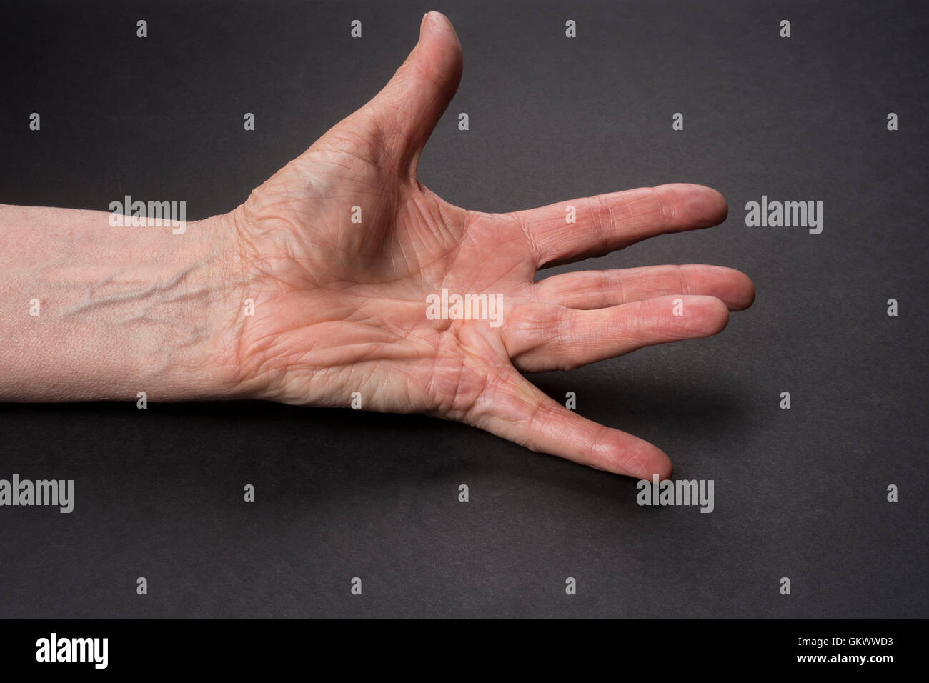 Dupuytren's Contracture or Syndrome of the ring finger of the left hand ...