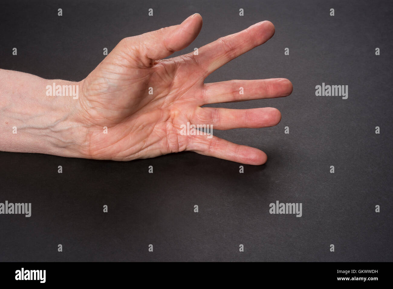 Dupuytren's Contracture or Syndrome of the ring finger of the left hand ...