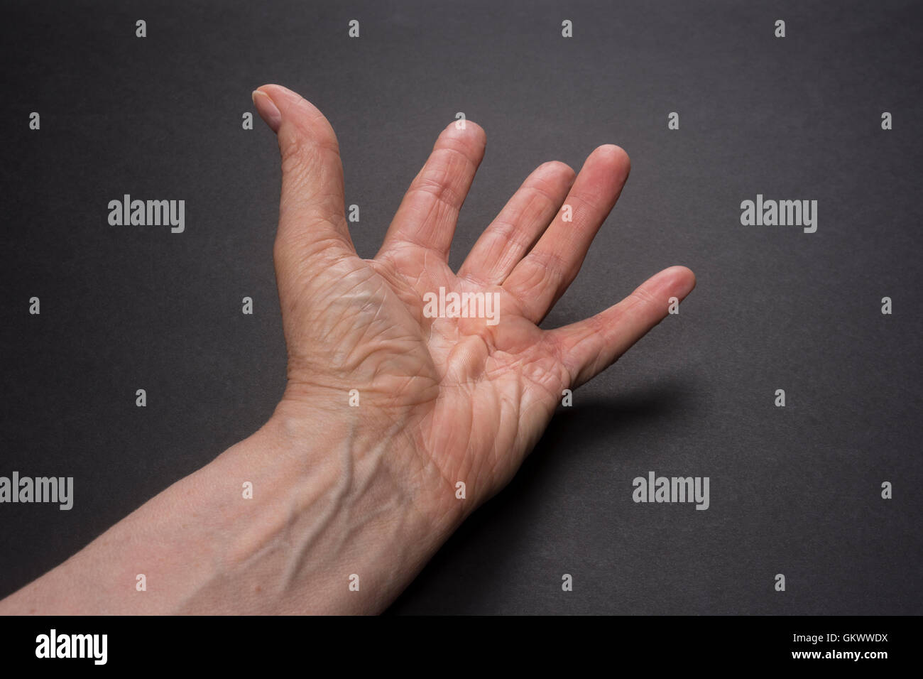 Skin contracture High Resolution Stock Photography and Images - Alamy