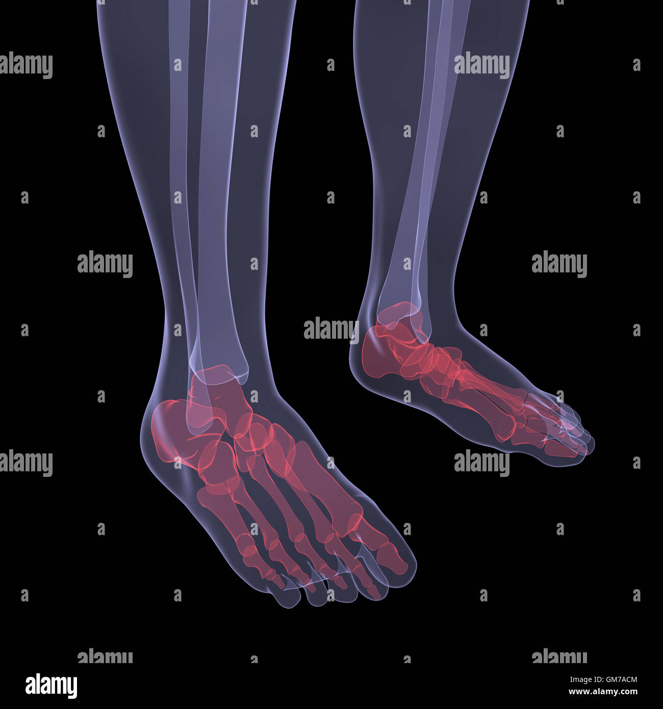 X-ray of human legs Stock Photo - Alamy