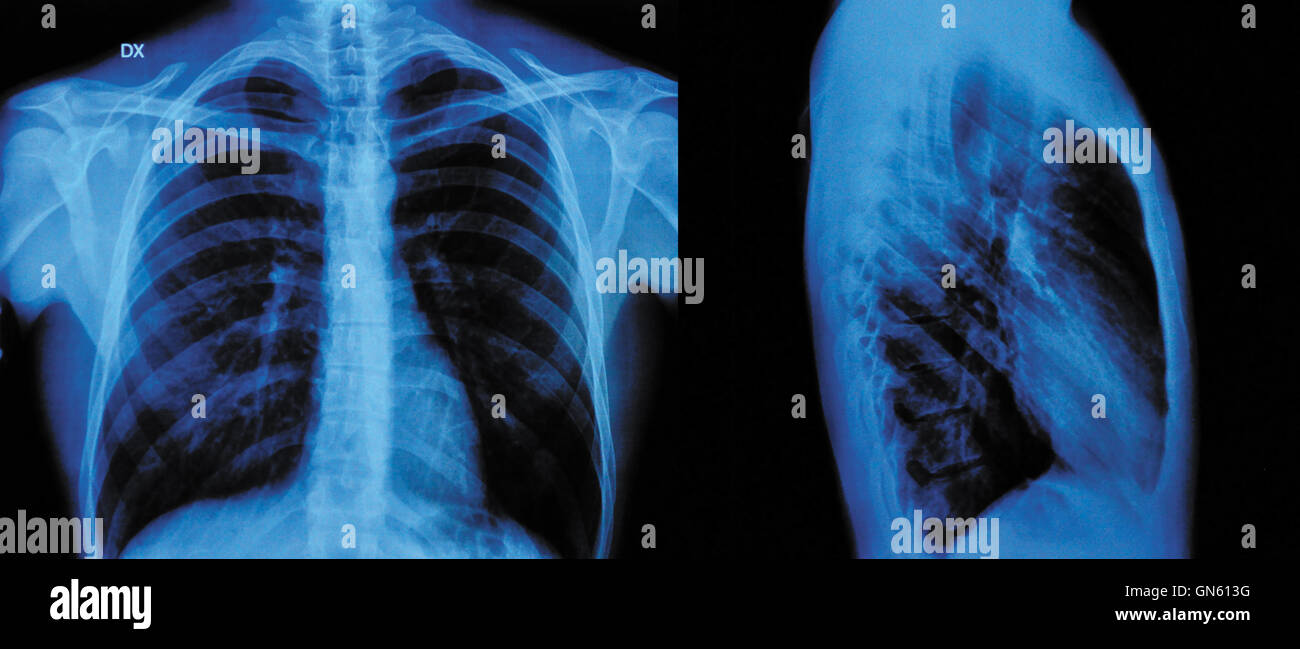 Normal Chest X Ray Vs Bronchitis