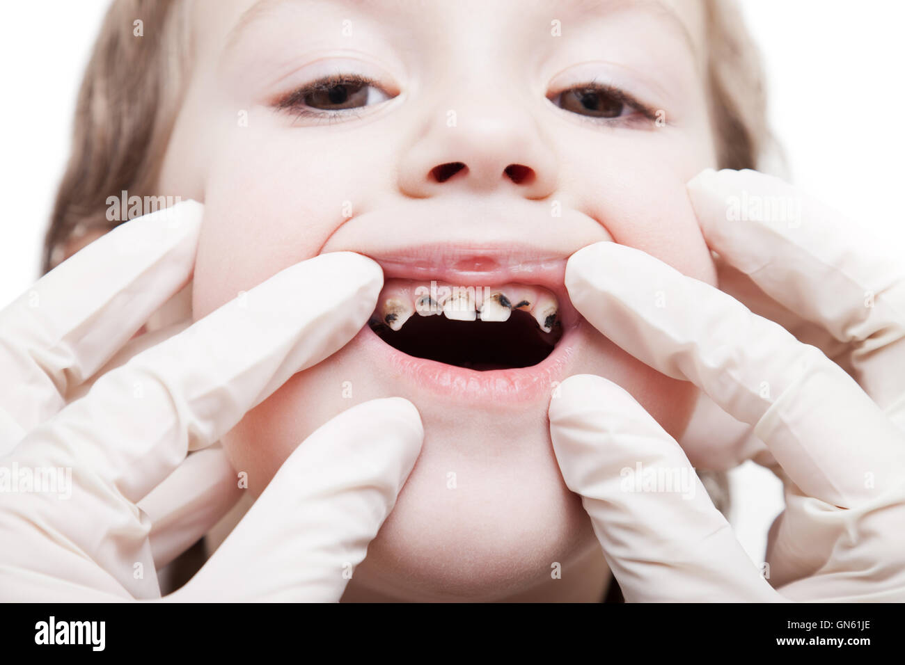 Examining caries teeth decay Stock Photo - Alamy