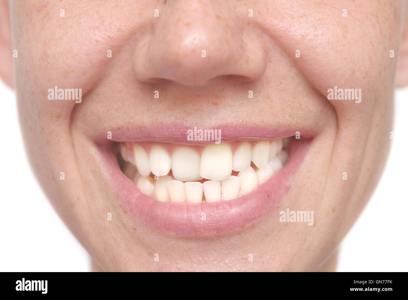 close up shot of crooked teeth Stock Photo - Alamy