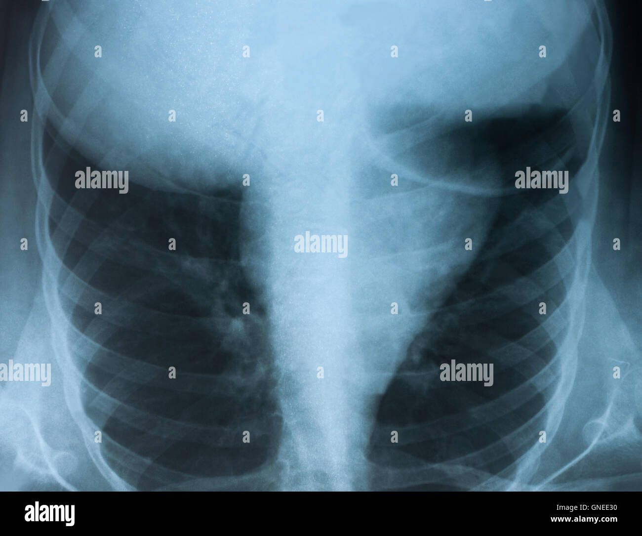 Chest bones hi-res stock photography and images - Alamy