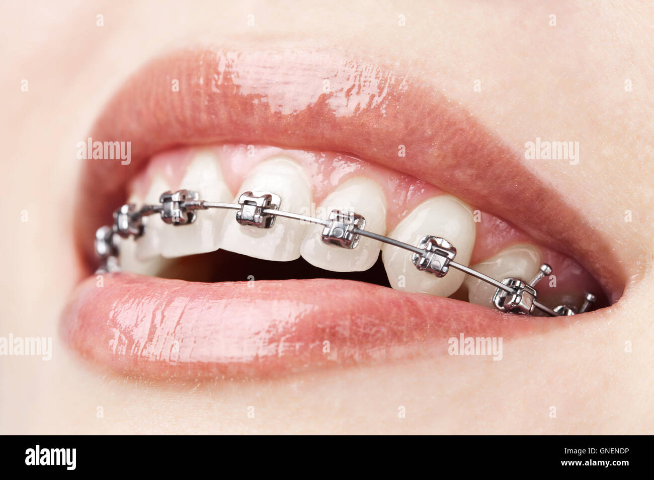 teeth with braces Stock Photo - Alamy