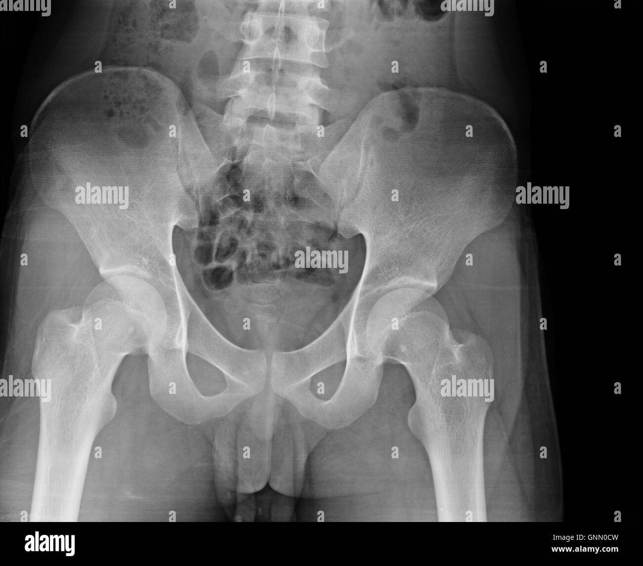 X-ray of the pelvis and spinal column Stock Photo - Alamy