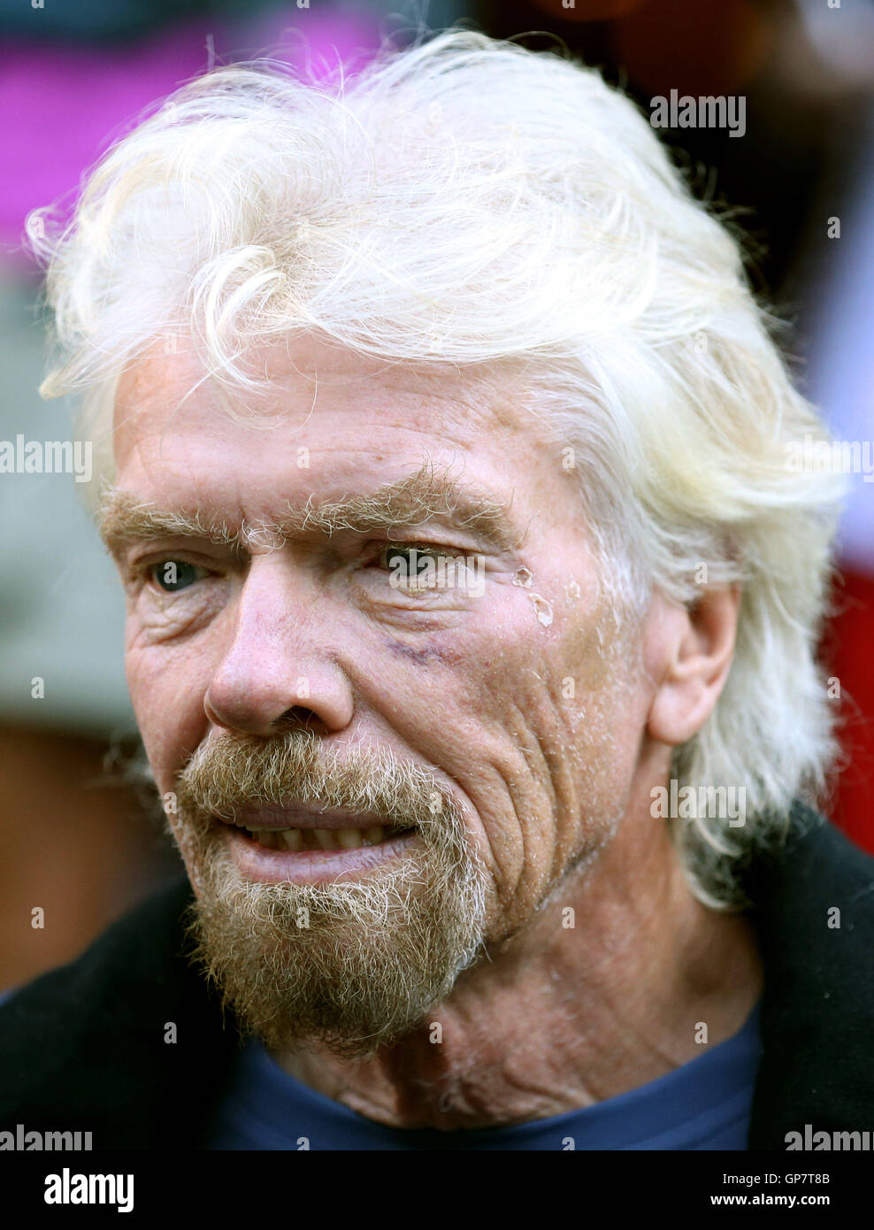 Sir Richard Branson with bruising and scarring still showing on his ...