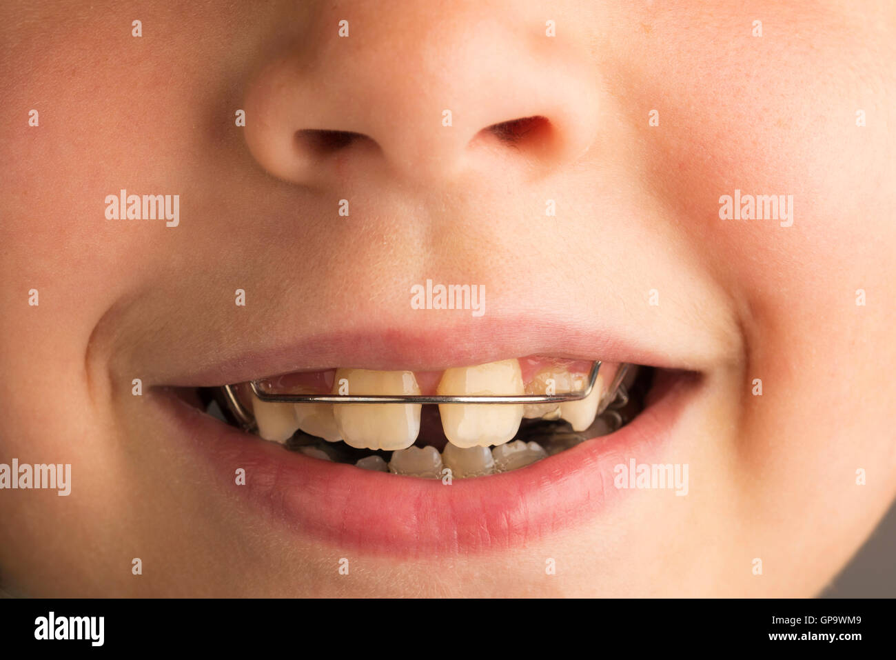 Closeup of smiling little girl wearing an orthodontic dental apparatus ...