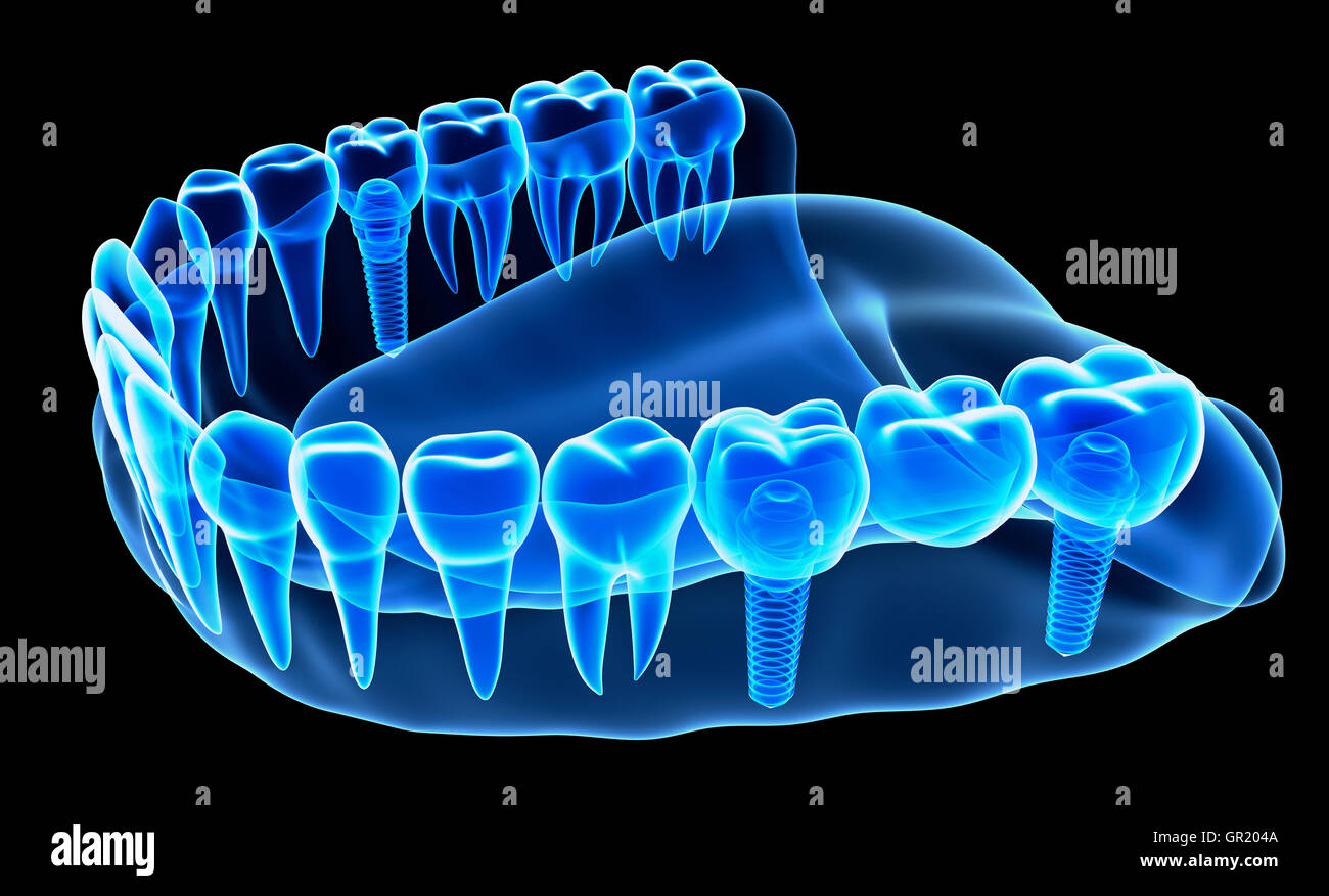 X-ray view of denture with implant Stock Photo - Alamy